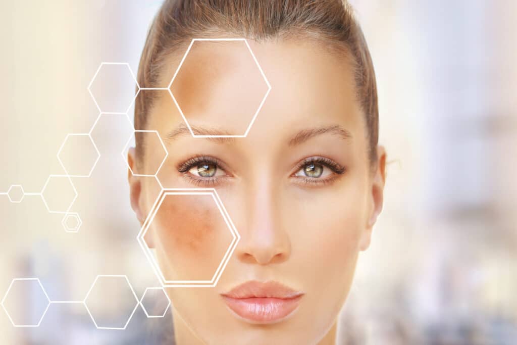 Macchie della pelle: scopri come sbiancarle grazie a queste creme ...